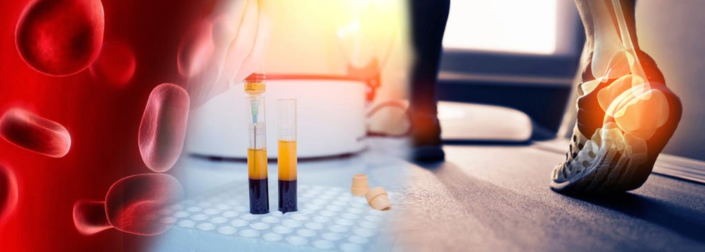 PRP Shoulder Injection | PRP for Shoulder Labral Tear